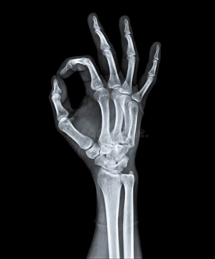 Radiografia da mão humana imagem de stock. Imagem de prognosis - 94157219