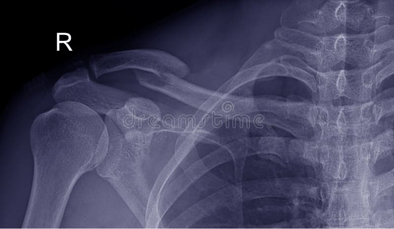 Radiografia Digital De Fratura Clavícula Imagem de Stock - Imagem de ...