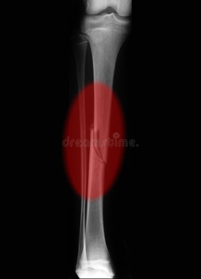Radiografia Quebrada Da Tíbia Imagem de Stock - Imagem de raio, trauma ...