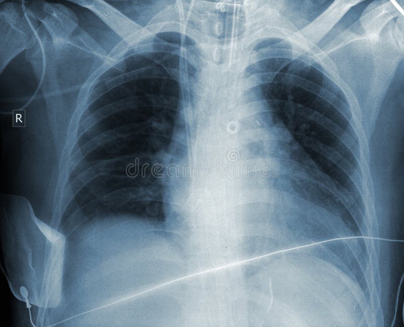 Radiogram Result of Patient Chest Stock Photo - Image of chest ...