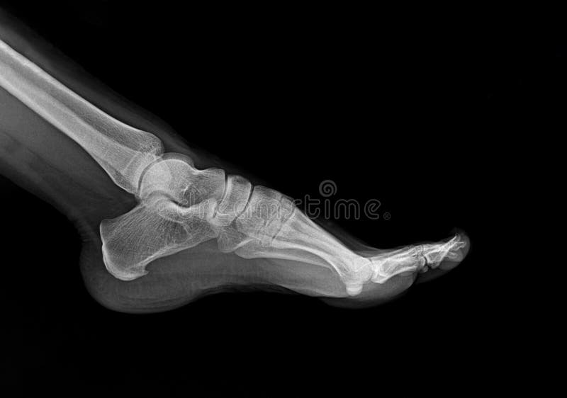 X-ray of the Foot Bones of a 22-year-old Woman, Heel Spur Stock Photo ...