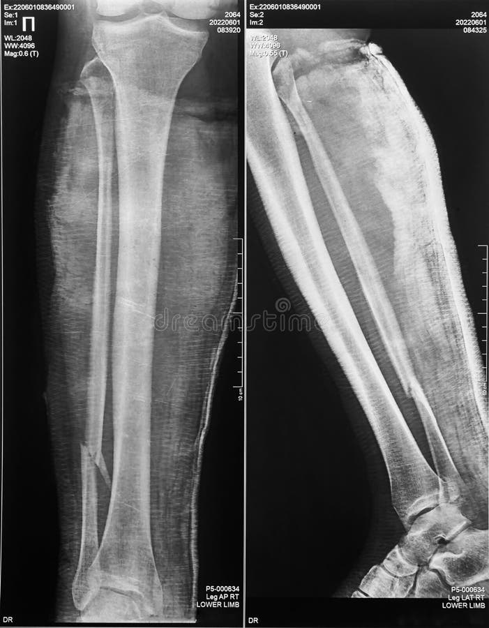 Fracture of the Lower Leg in a Cast. Stock Image - Image of closeup ...