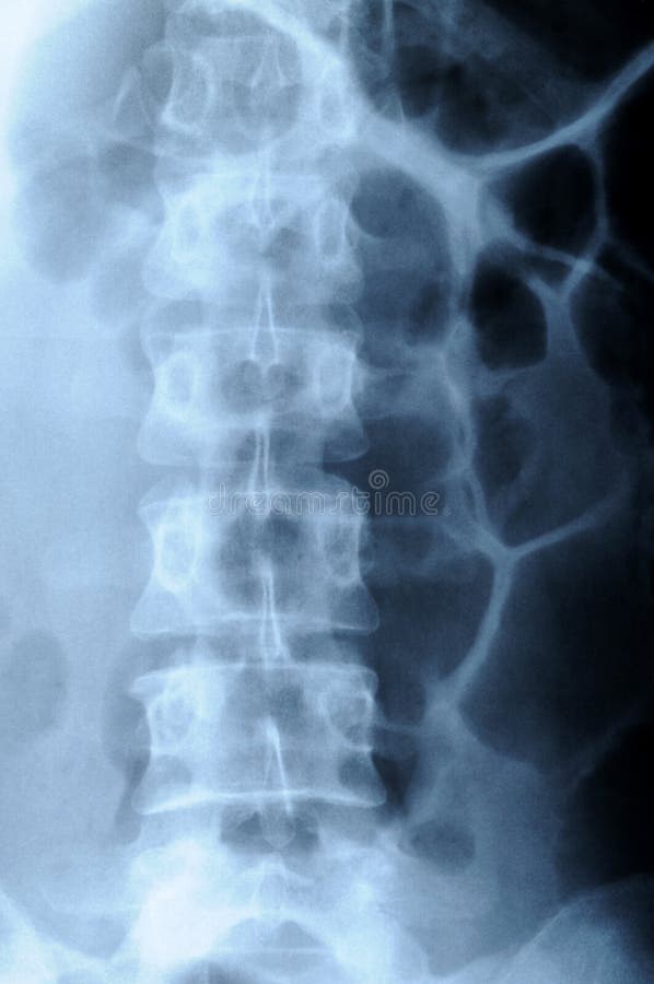 Radiograph of Human Backbone Stock Image - Image of skeleton, medical ...