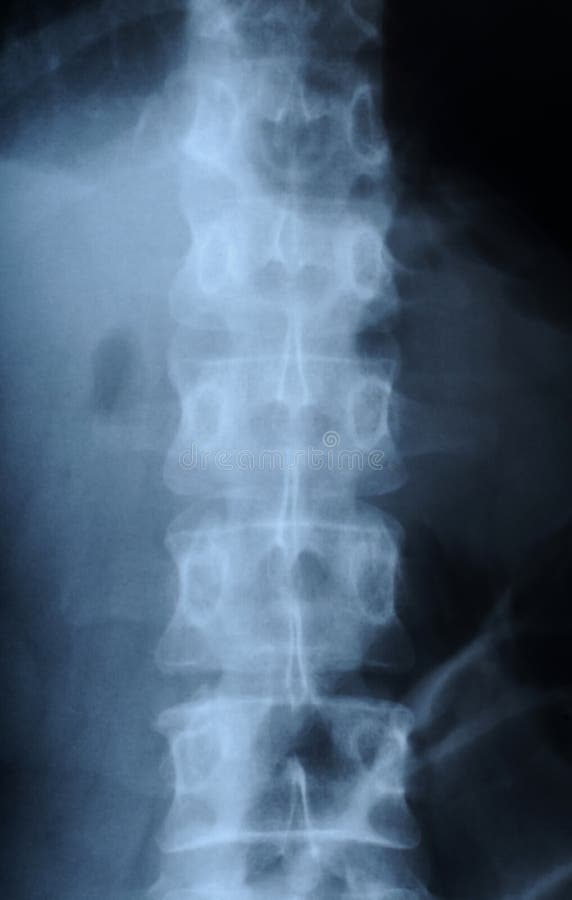 Radiograph of Human Backbone Stock Image - Image of diagnosis, medical ...