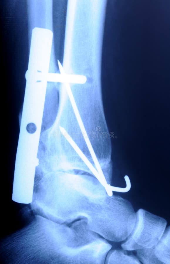 Rtg Broken Leg Stock Photos - Free & Royalty-Free Stock Photos from ...