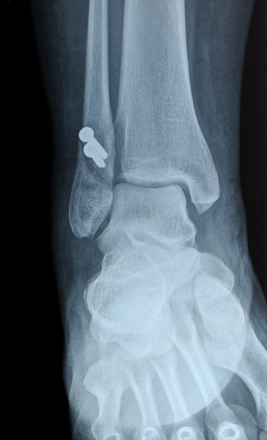 Radiograph of Human Fracture Fibula Bone Stock Image - Image of xray ...