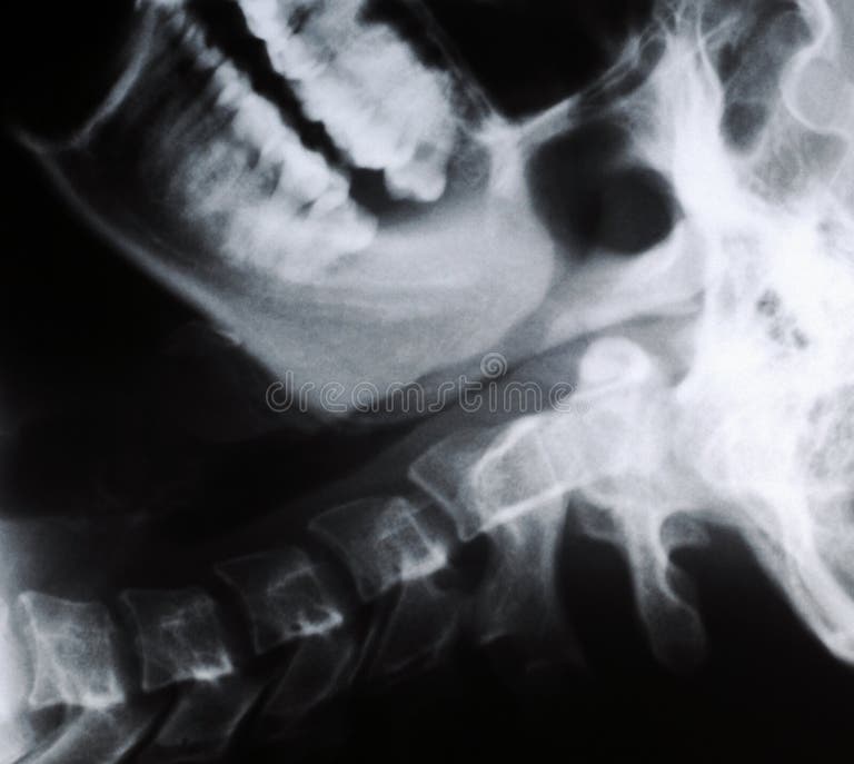 Radiograph of human neck stock image. Image of cranium - 18643053