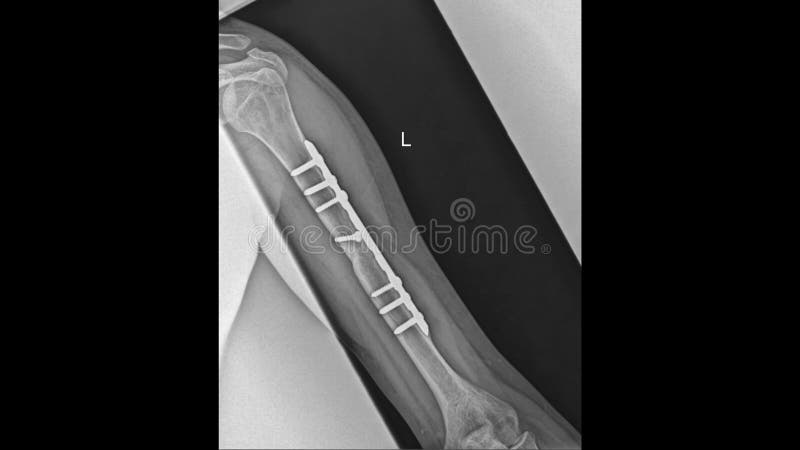 Radiograph of Humerus Fracture: Evaluation of Surgical Fixation Video ...