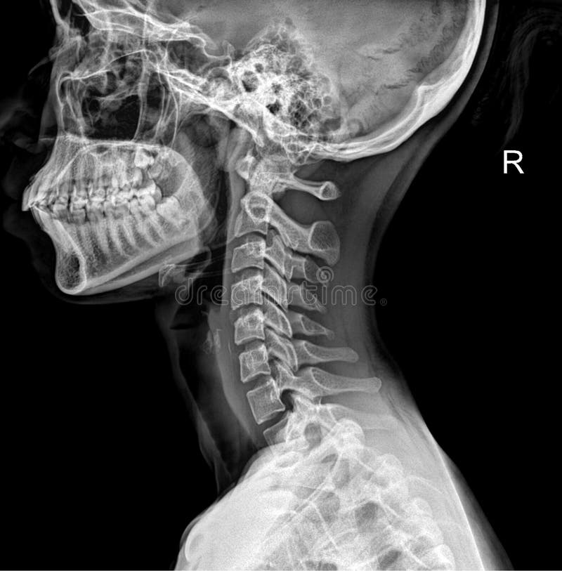 Radiograph of Neck and Cervical Spine Lateral View. Stock Image - Image ...