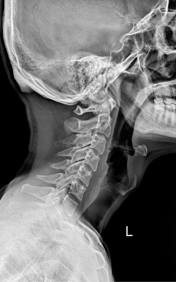 Radiograph of Neck and Cervical Spine Lateral View. Stock Photo - Image ...