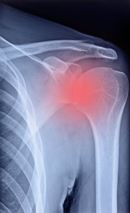Radiograph of the shoulder stock photo. Image of hospital - 63048824