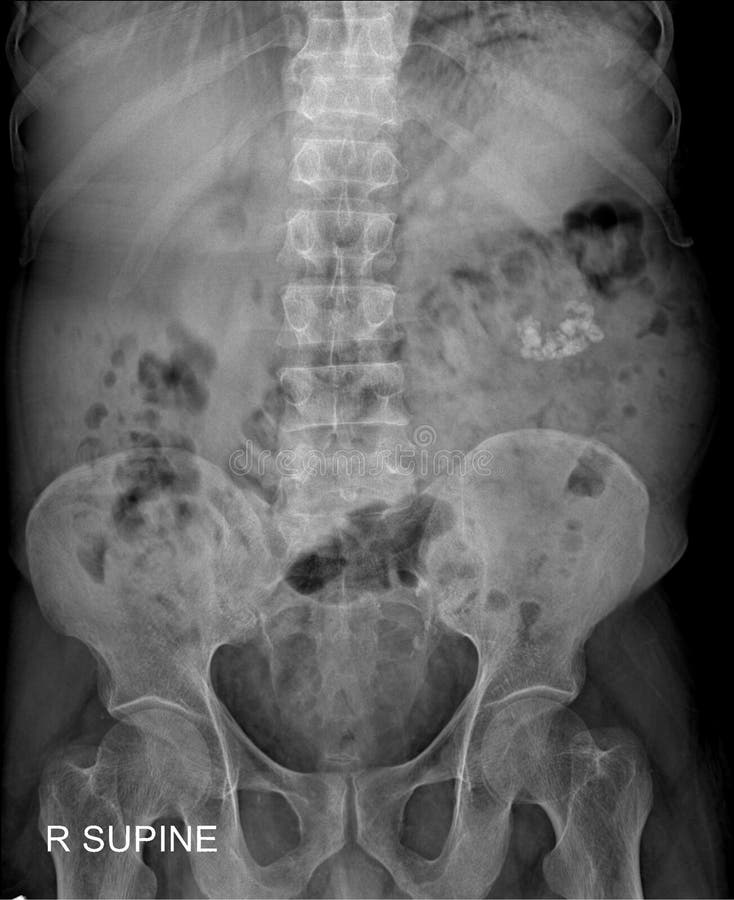 Radiographic Image of a KUB (kidneys, Ureters, Bladder) Stock Image ...