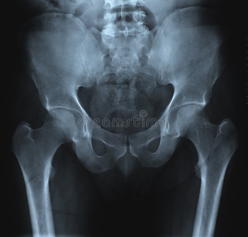 Radiographie du bassin image stock. Image du spinal, bassin - 41087475