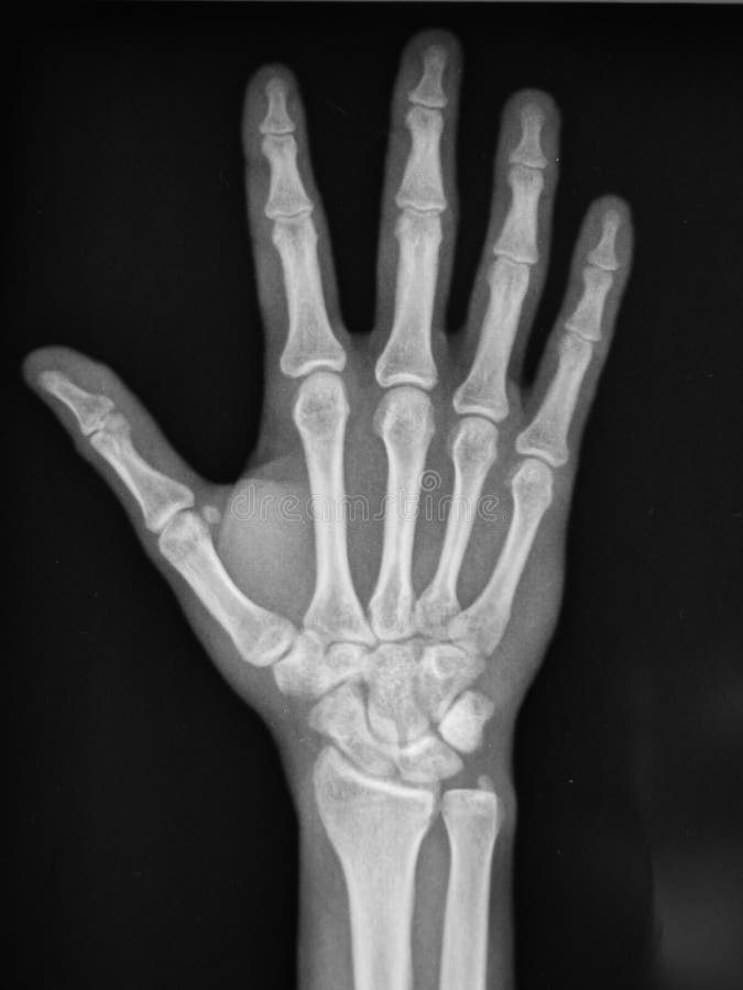 Radiographie De Main Et De Poignet Photo stock - Image du diagnostic ...