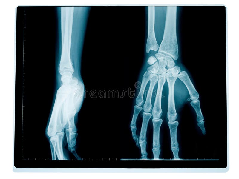 Radiographie De Main Et De Poignet Photo stock - Image: 9088304