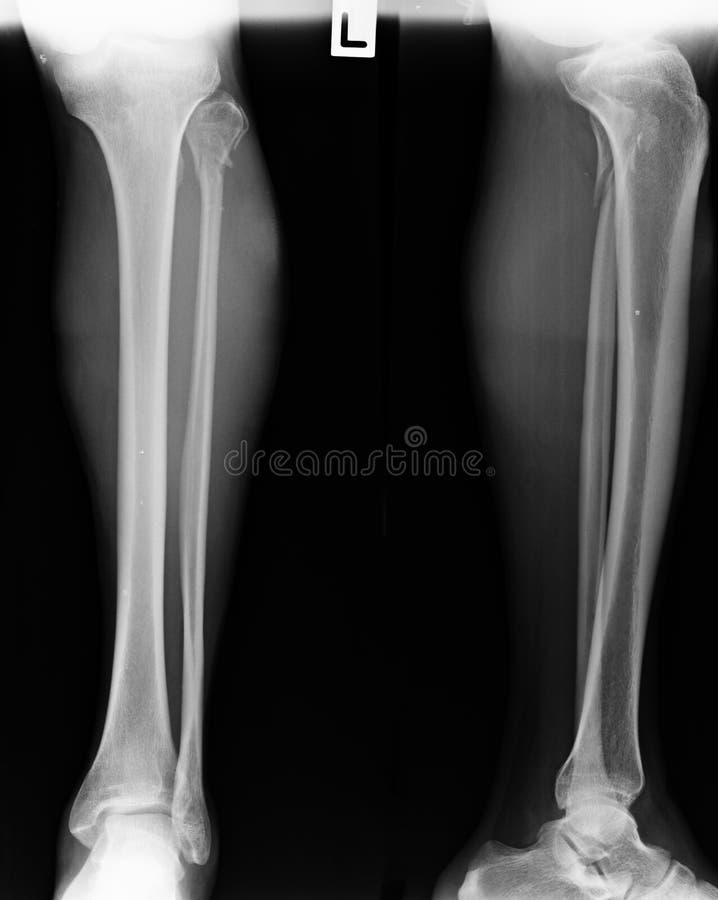 Radiographie Limage Des Patients De Fracture De Jambe Photo Stock