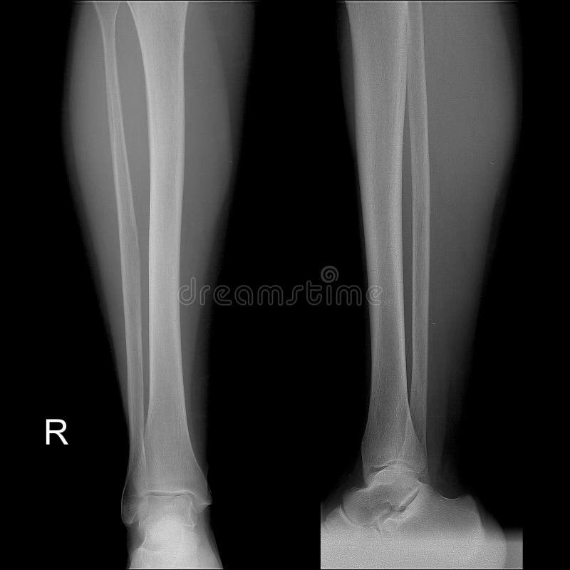 Radiographiez L'image Du Tibia, Normale Frontale De Vue De Sagital ...