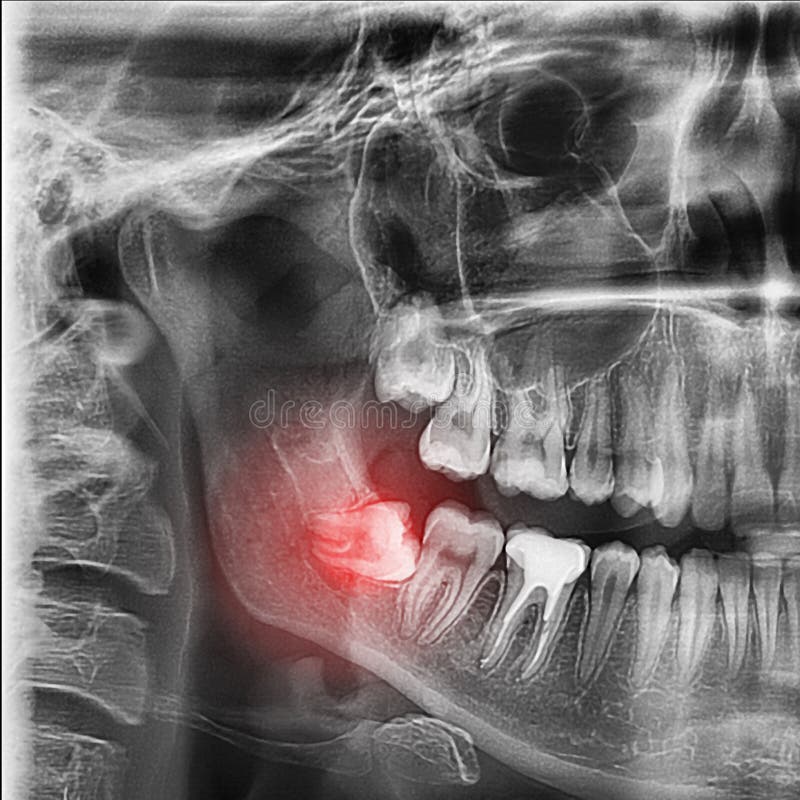 Radiographs of the teeth stock image. Image of lower - 167723025