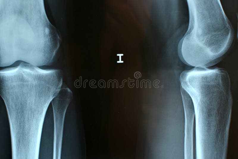 Radiografia Quebrada Da Tíbia Imagem de Stock - Imagem de doença ...
