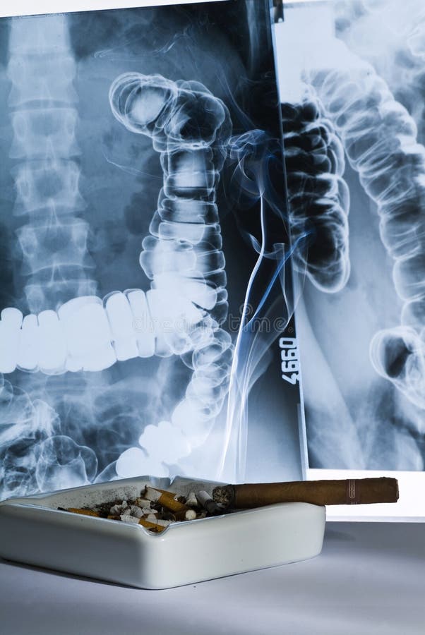 Radiography and cigarettes stock image. Image of ashtray - 24766063