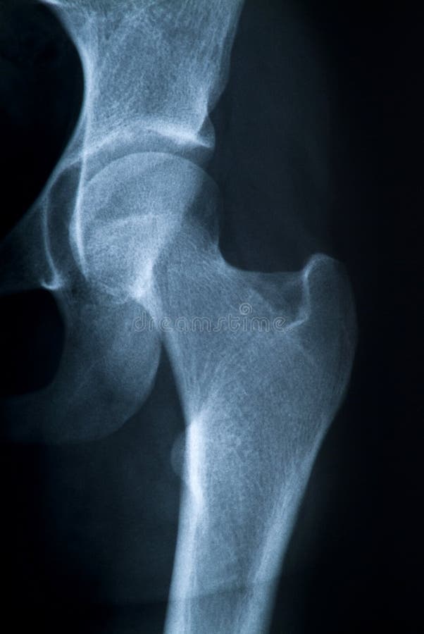Radiography of the femur stock photo. Image of light - 24766136
