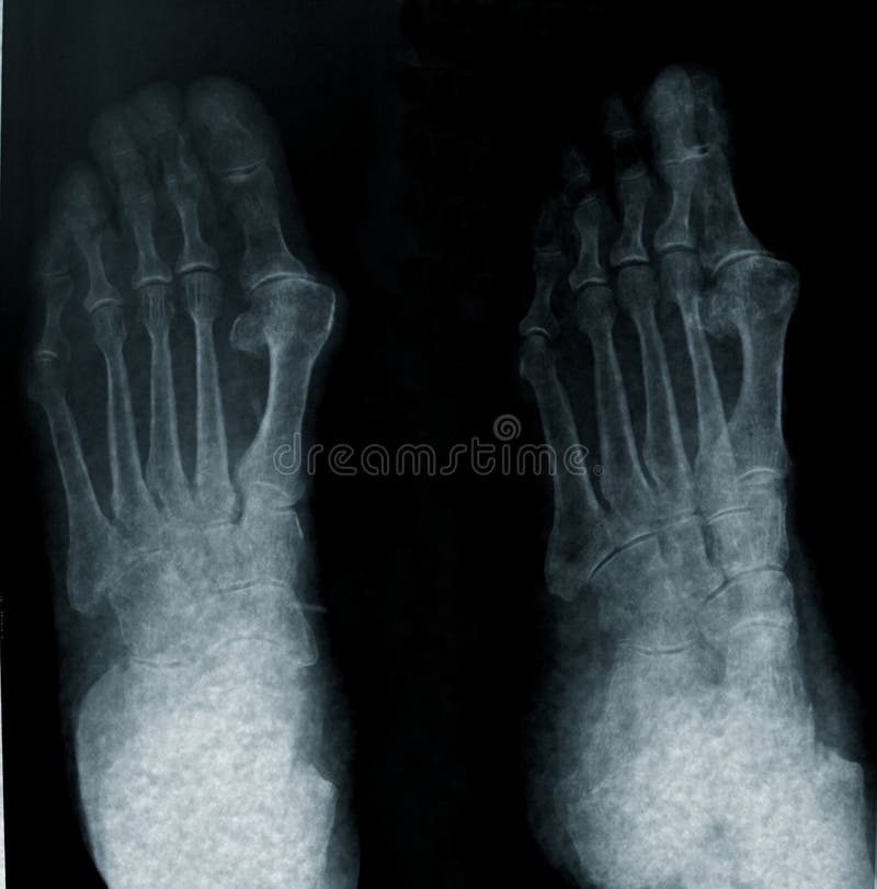 Foot radiography stock photo. Image of clinical, bone - 8655586