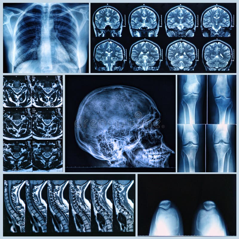 Radiography of Human Bones stock photo. Image of body - 31258960