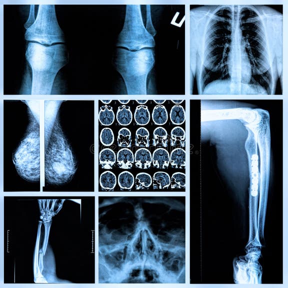 Radiography of Human Bones stock photo. Image of bones - 43632686