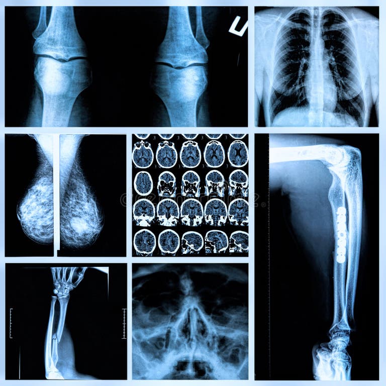 Radiography of Human Bones stock photo. Image of bones - 43632686