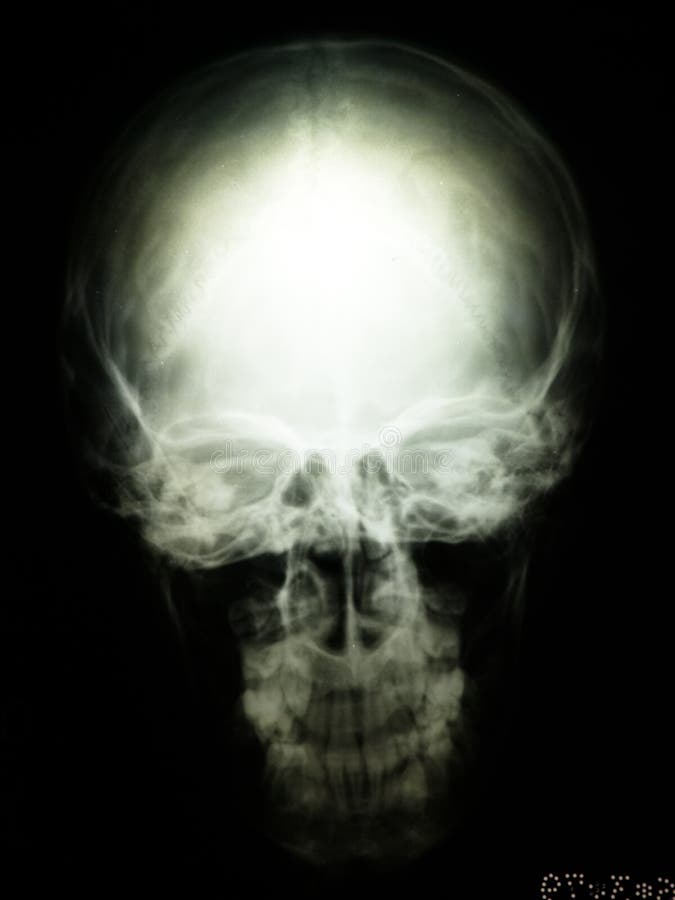 Radiography of skull stock image. Image of exam, equipment - 6900505