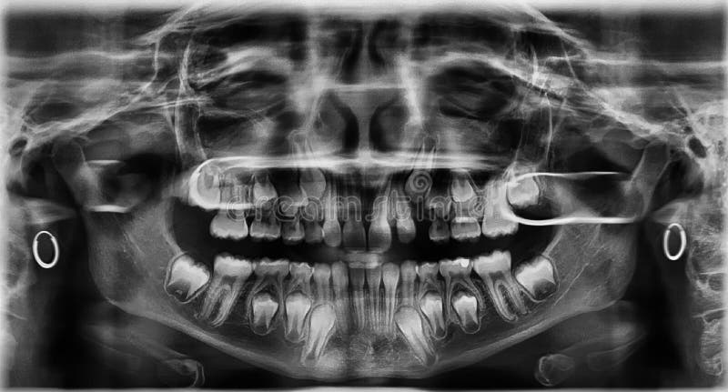 Radiography teeth stock image. Image of medicine, dental - 54090241