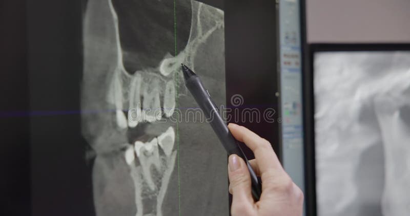 Radiologist Dentist Doctor Looking at Teeth 3D X-ray on Desktop ...