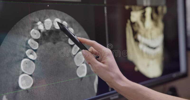 Radiologist Dentist Doctor Looking at Teeth 3D X-ray on Desktop ...