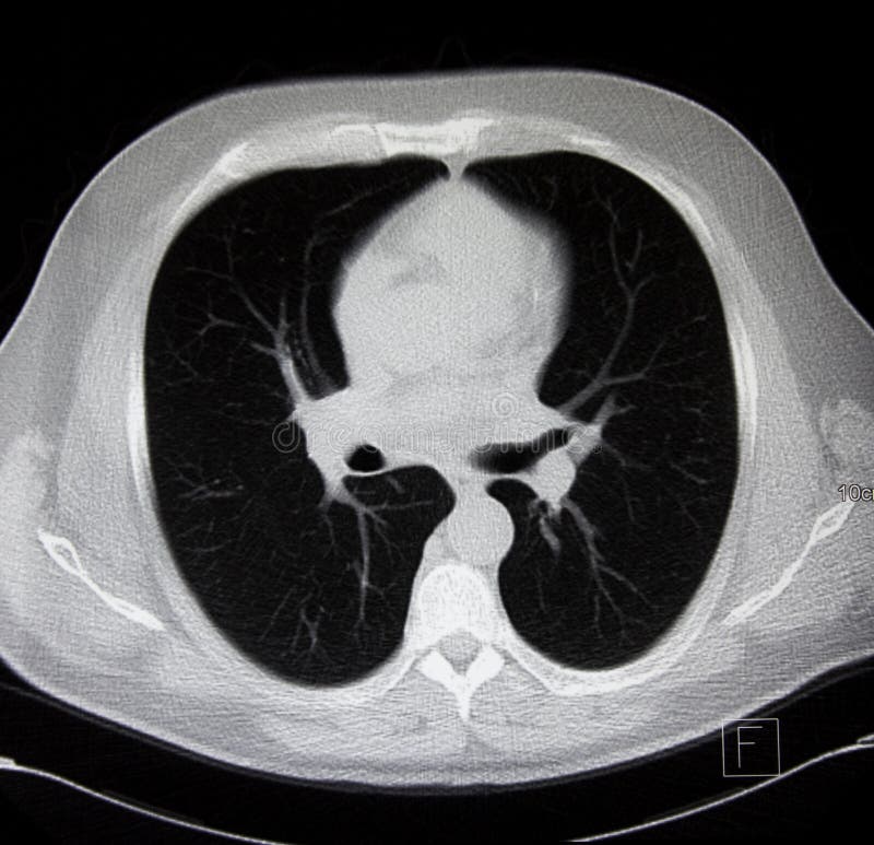 Radiology, MSCT (computed Body Tomography)of Chest Stock Image - Image ...