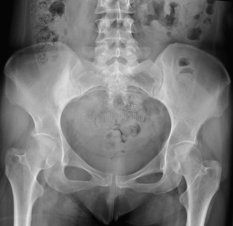 Raggi X maschii del bacino immagine stock. Immagine di immagine - 10049583
