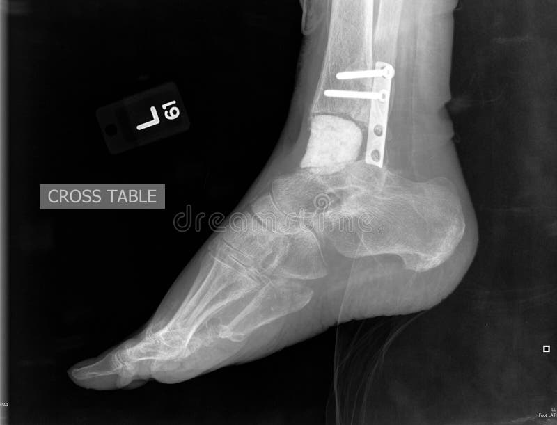 Raggi X Dell'osso Rotto Del Femore Immagine Stock - Immagine di medico ...