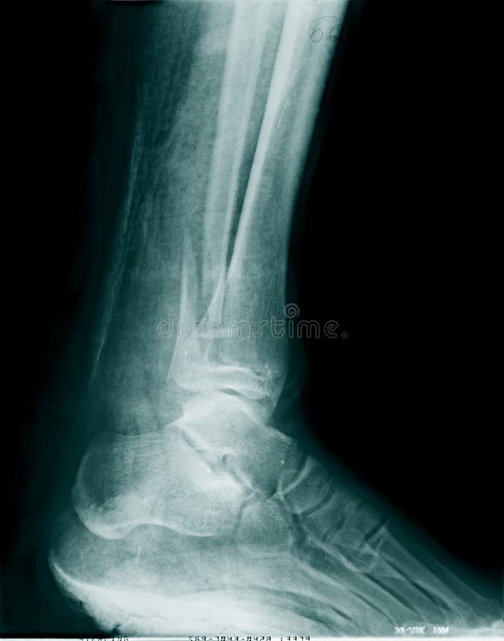 Radiografia del piede fotografia stock. Immagine di diagnosi - 9261118