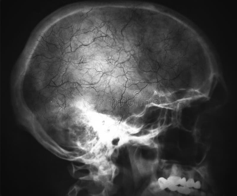 Faccia I Raggi X Dell'immagine O Del Rontgen Del Cranio Umano, Primo ...