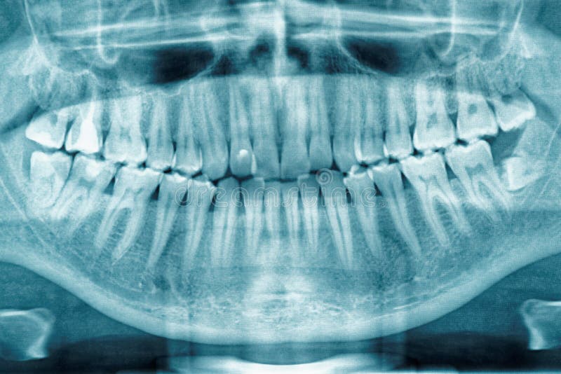 Raggi X dentali panoramici fotografia stock. Immagine di orizzontale ...