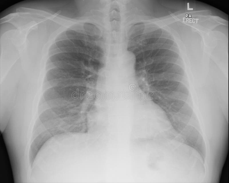 Raggio X O Radiografia Della Mano Fotografia Stock - Immagine di ...