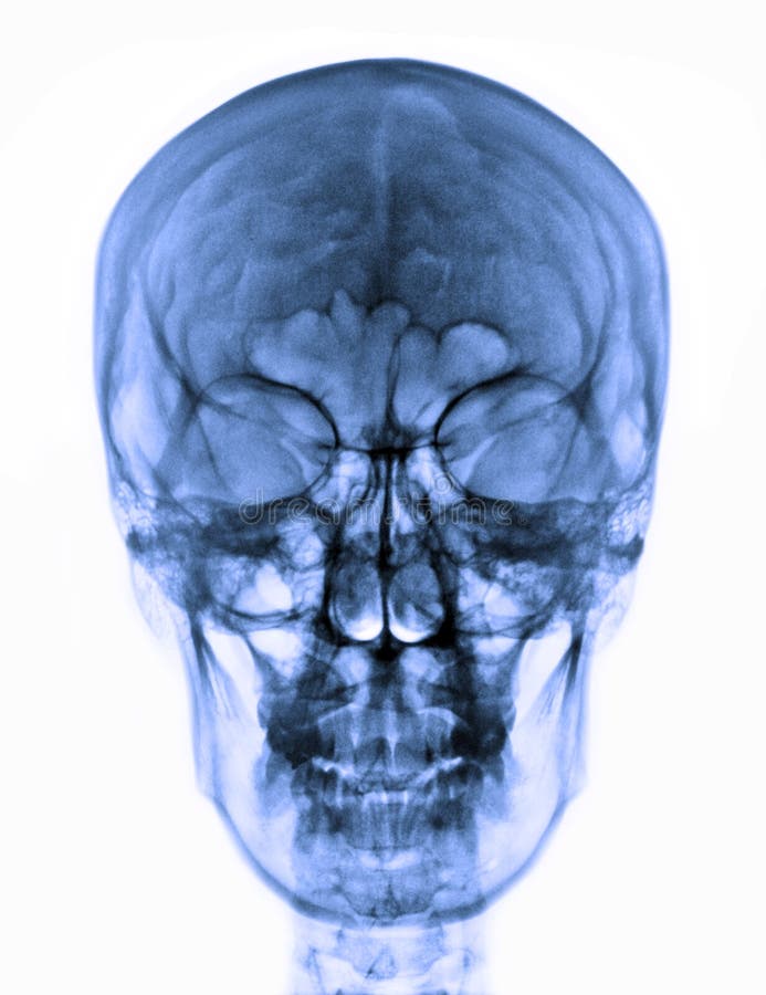 Raggi X del cranio immagine stock. Immagine di rontgen - 3455643