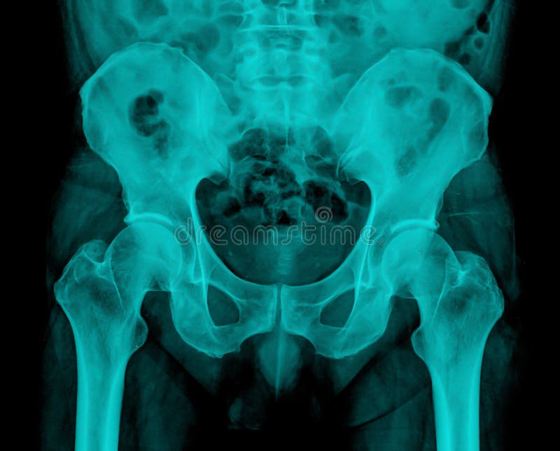 Raggi X normali del bacino immagine stock. Immagine di giunto - 4725683