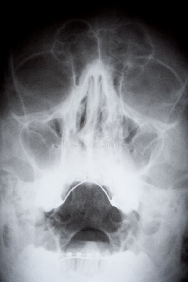 Raggi X Della Testa E Del Collo Fotografia Stock - Immagine di foto ...