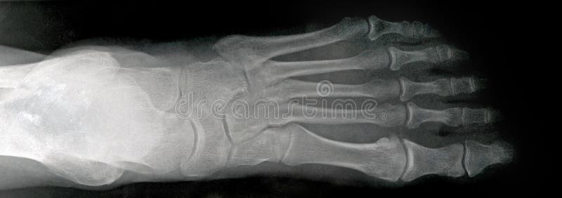 Radiograph Do Tornozelo Humano Da Fratura Foto de Stock - Imagem de ...