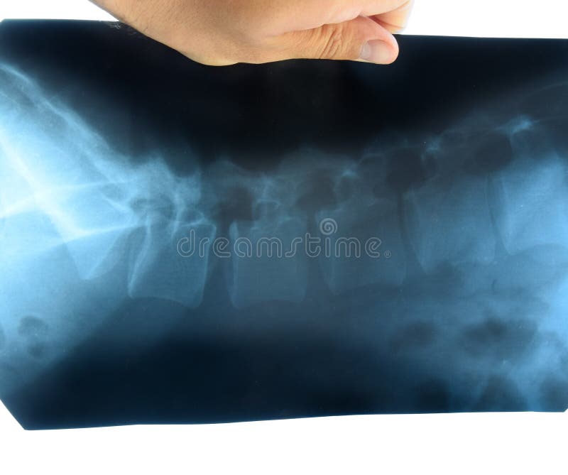 Raio X Da Coluna Lombar, Coluna No Raio X Imagem de Stock - Imagem de ...