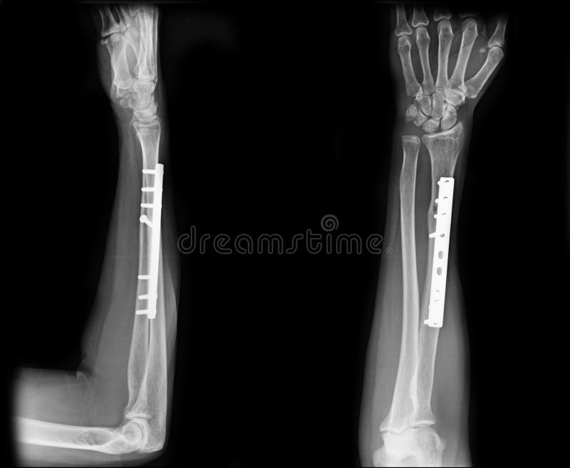 Eixo Da Fratura De Raio & Do Osso Ulnar Imagem de Stock - Imagem de ...