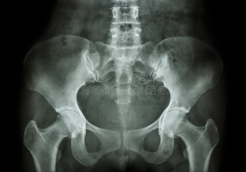 Filme a Pelve Do Raio X Do Paciente E Da Artrite Da Osteoporose Ambos ...