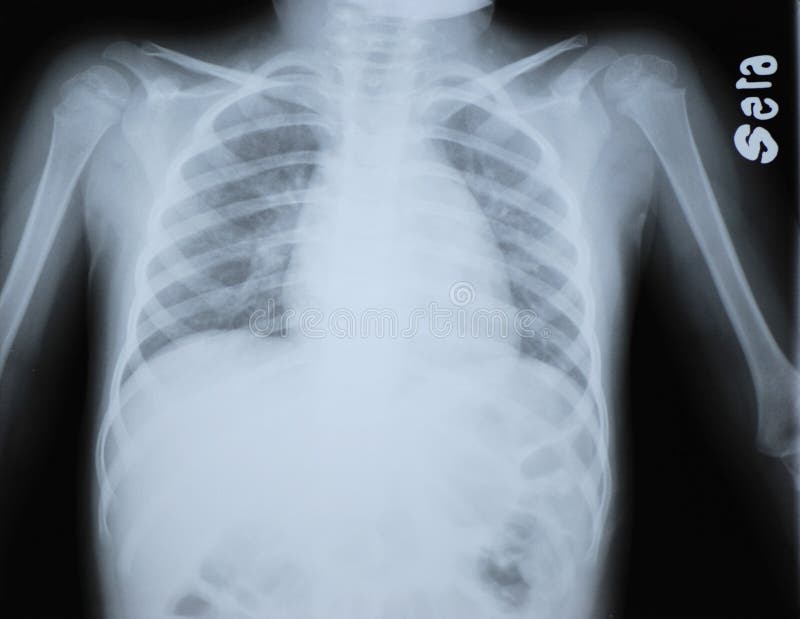 Corpo De S Da Criança Do Raio X Do Filme '(bebê Normal) Imagem de Stock ...