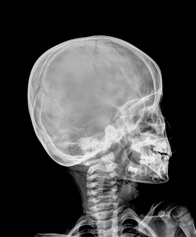 Crânio Do Raio X E Caixa Da Criança Imagem de Stock - Imagem de doutor ...