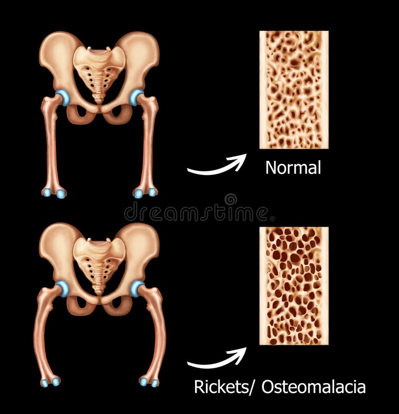 Rakitis-osteomalacia stock illustrationer. Illustration av brott - 75699746